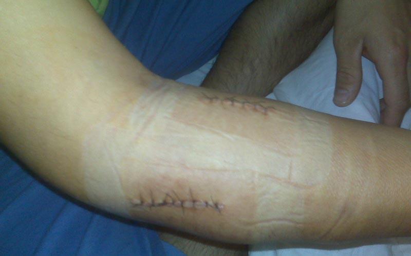 World Superbikes: Michel Fabrizio undergoes successful arm pump ...